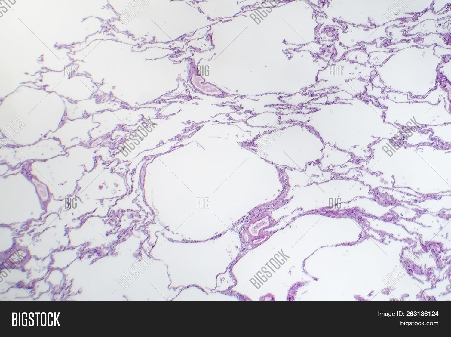 Diffuse Lung Emphysema Image & Photo (Free Trial) | Bigstock