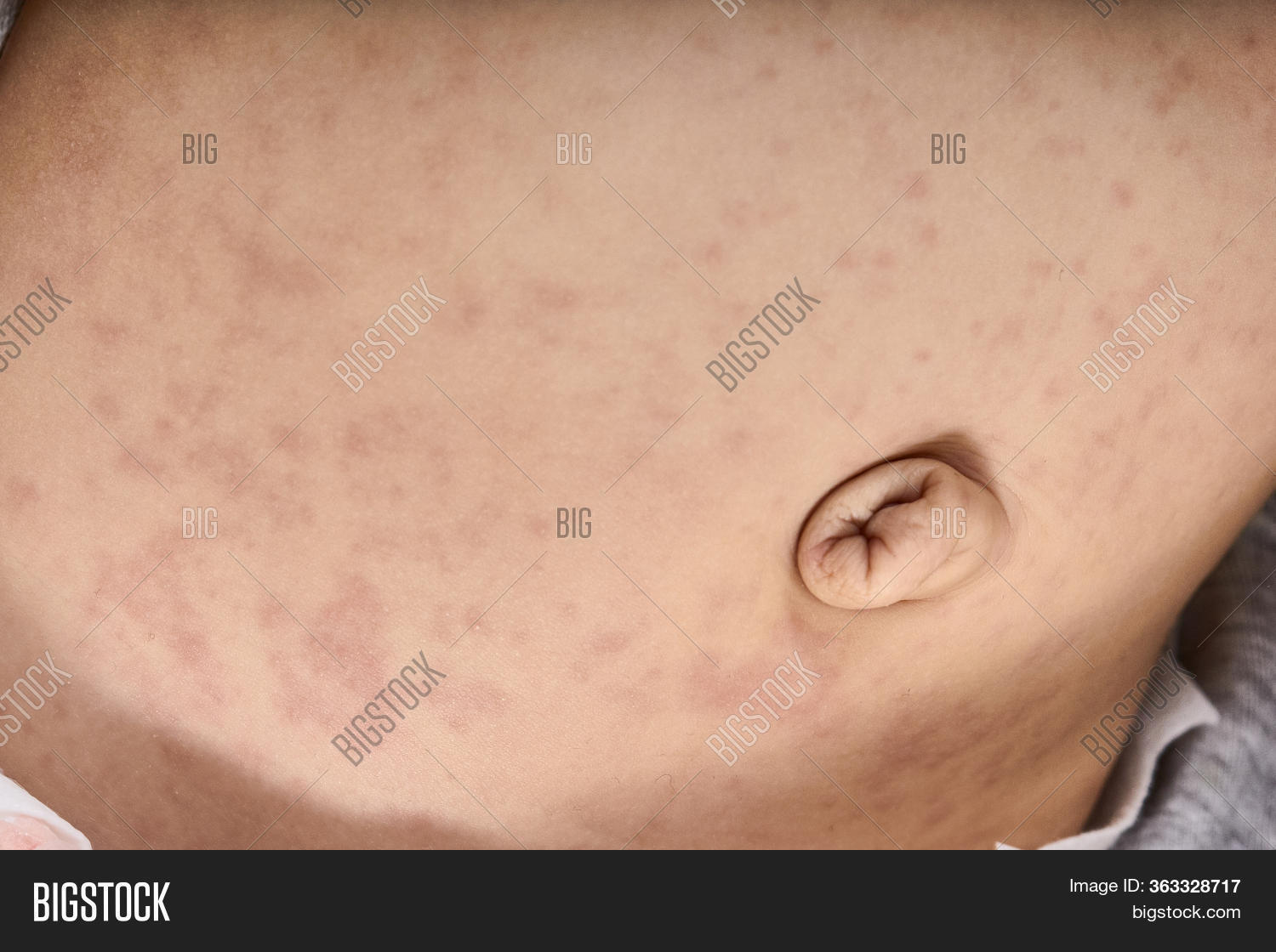 Child Has Rash, Long Image & Photo (Free Trial) | Bigstock