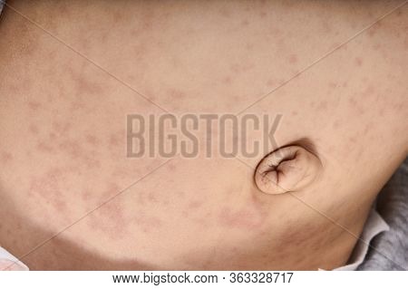 Child Has Rash, Long Image & Photo (Free Trial) | Bigstock