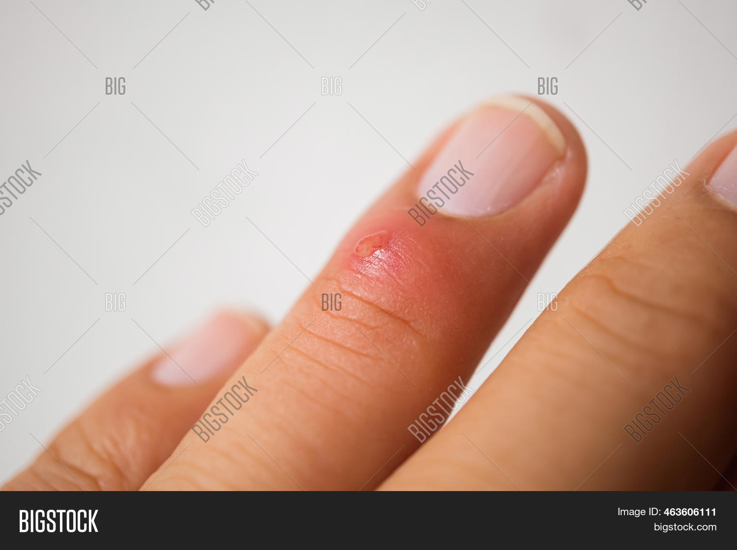 Close- Photo Wound Image & Photo (Free Trial) | Bigstock