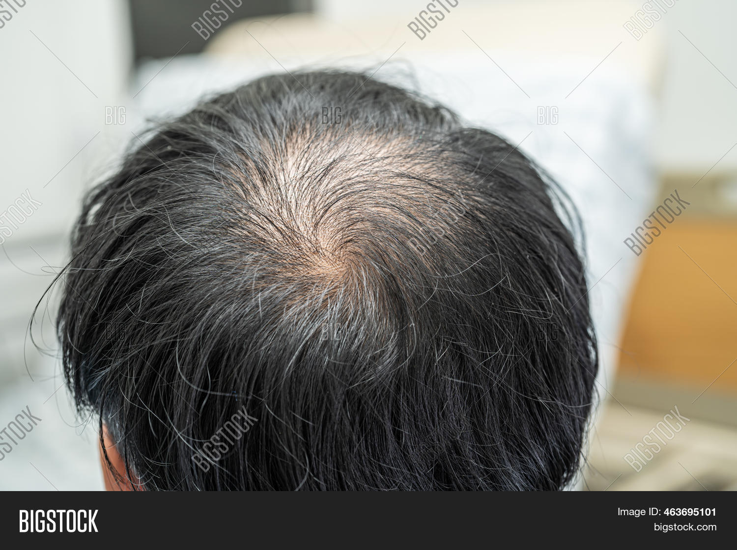 Bald Middle Head Begin Image & Photo (Free Trial) | Bigstock