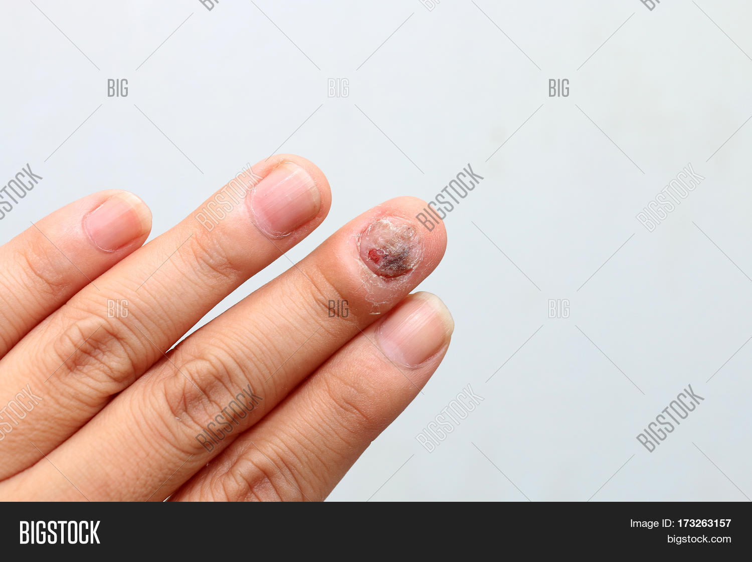 Fungal Nail Infection Image & Photo (Free Trial) | Bigstock