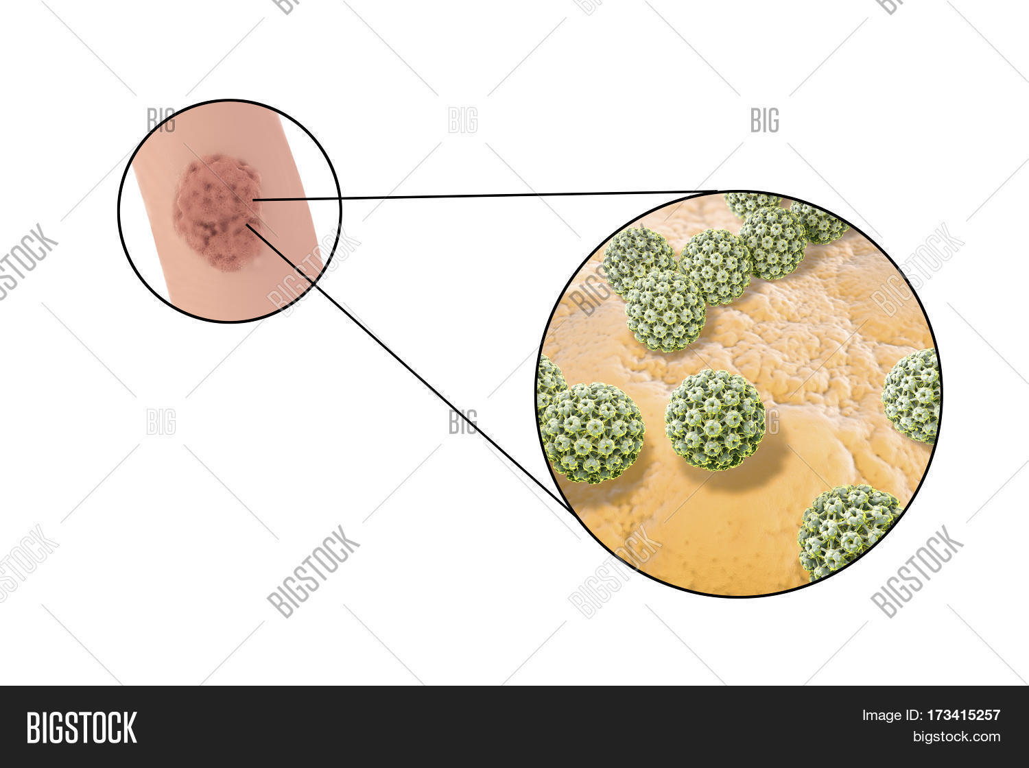 Human Papillomavirus Image & Photo (Free Trial) | Bigstock