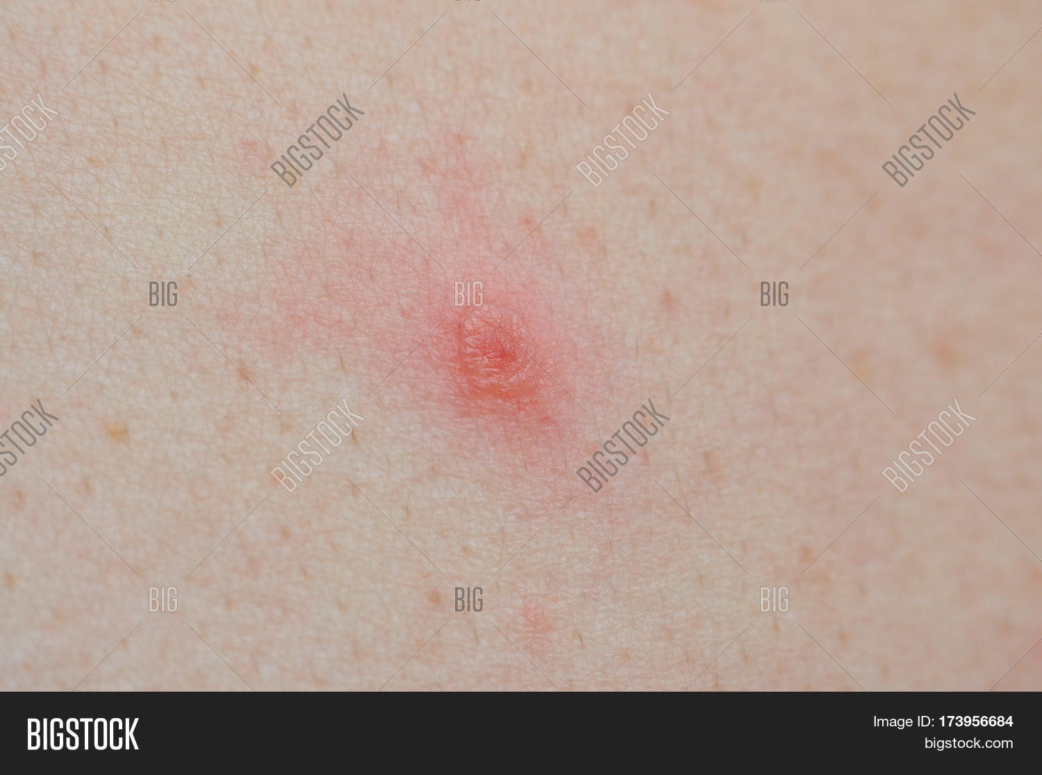Chickenpox (varicella Image & Photo (Free Trial) | Bigstock