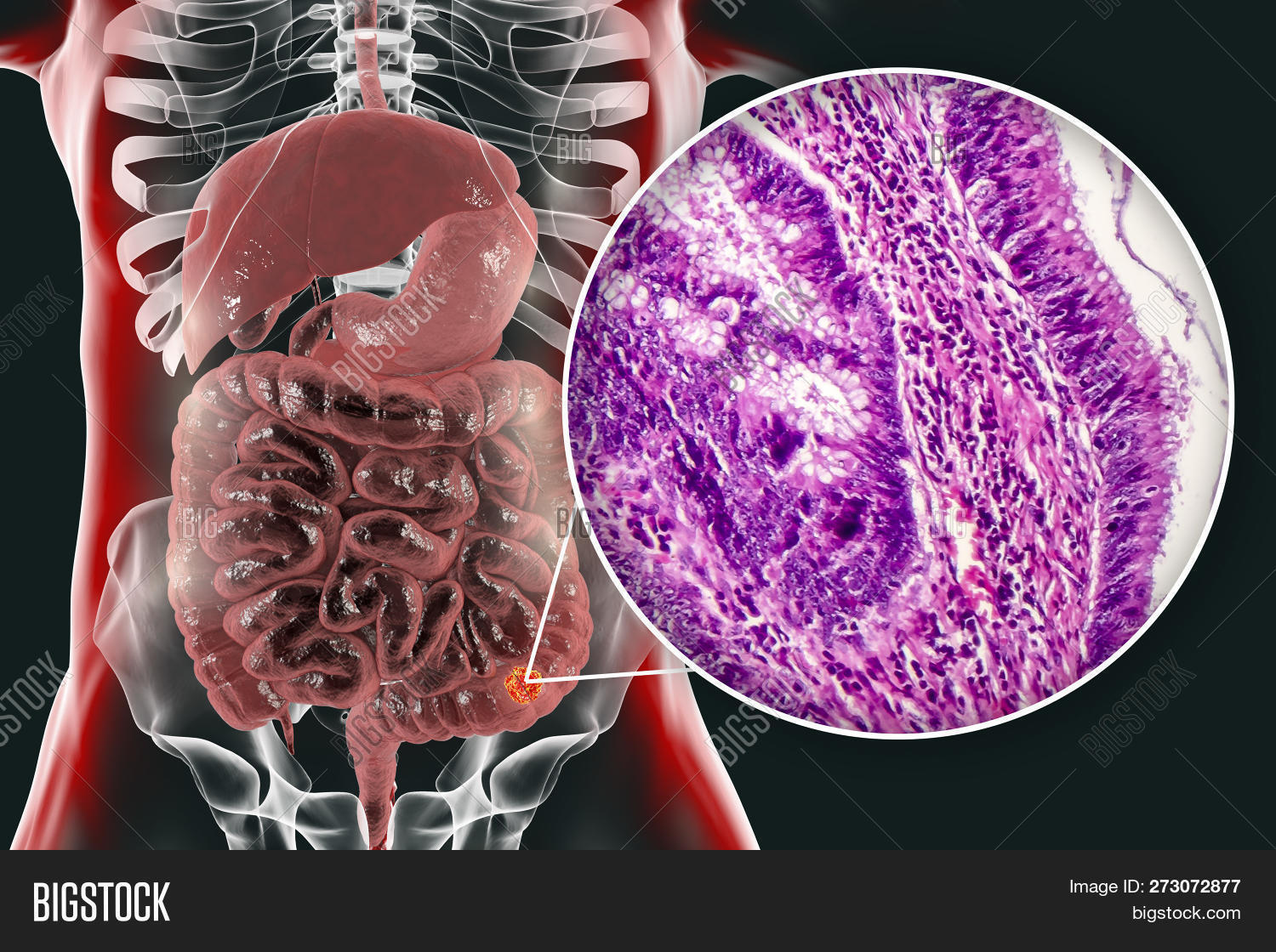 Colon Cancer, 3d Image & Photo (Free Trial) | Bigstock