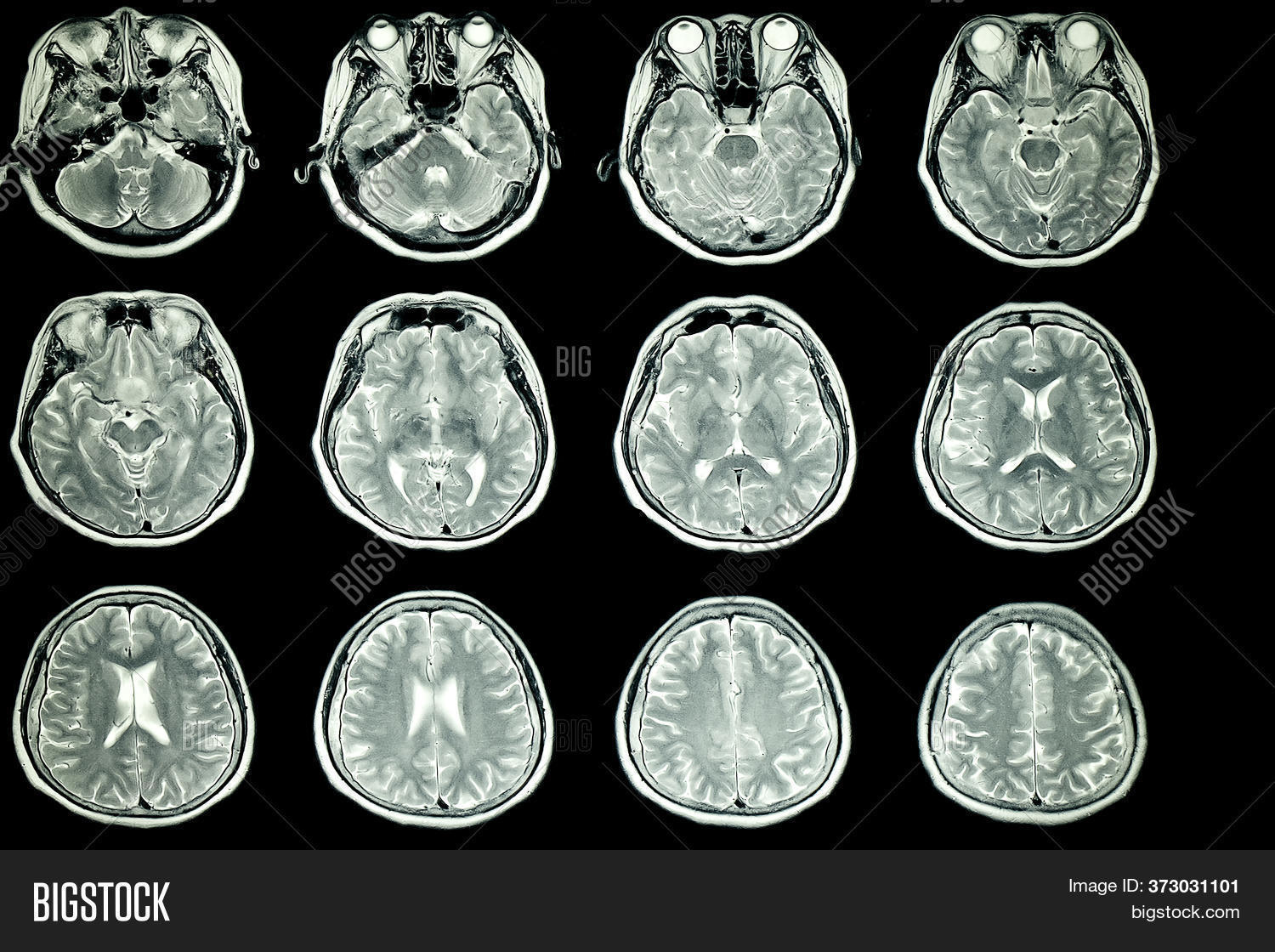 Mri Scan Patient Brain Image & Photo (Free Trial) | Bigstock
