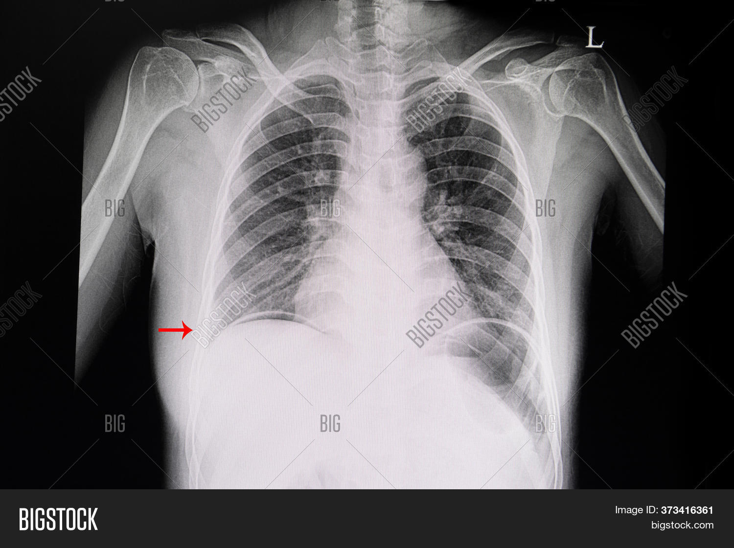 Chest Xray Film Female Image & Photo (Free Trial) | Bigstock