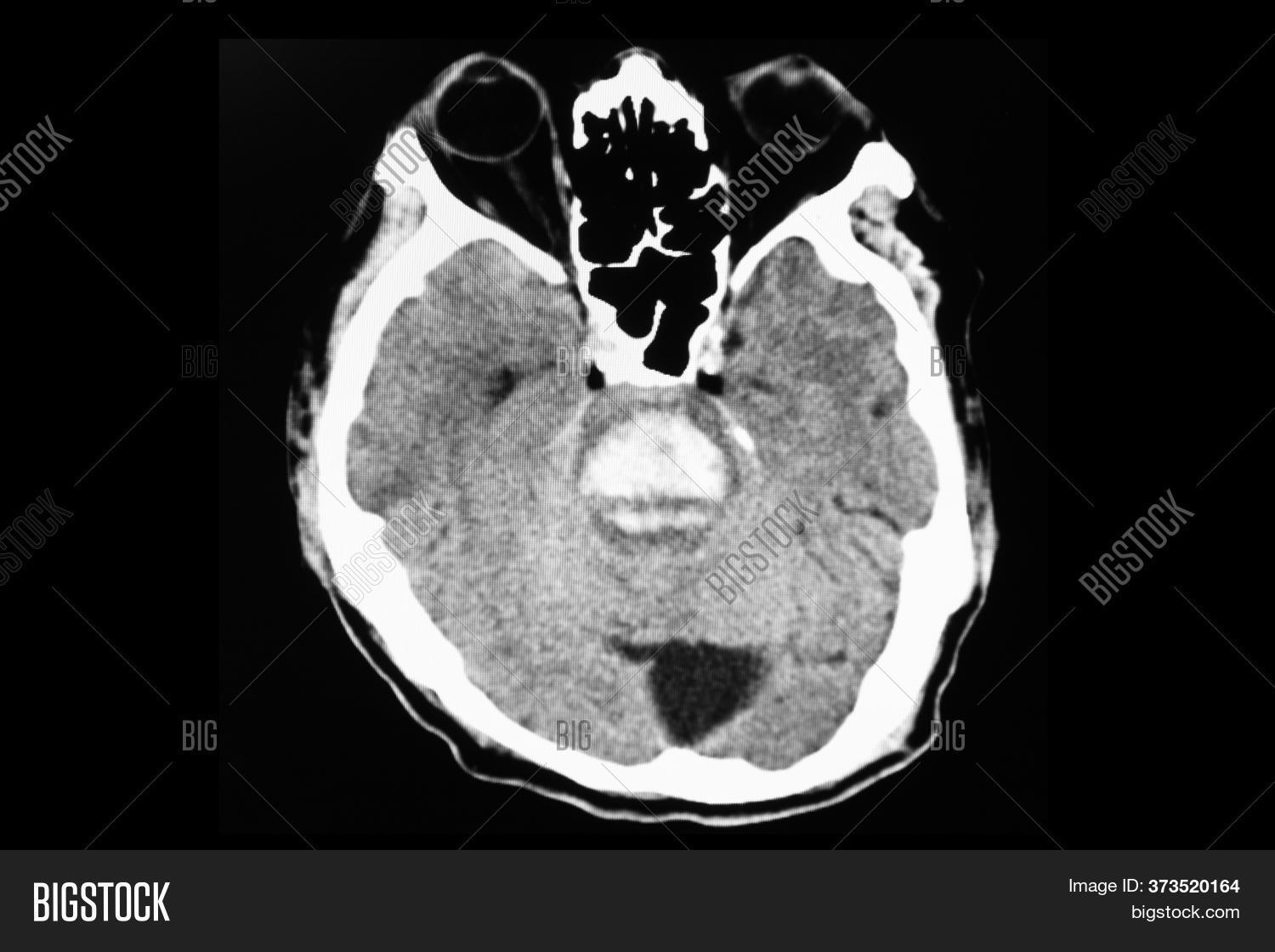 Ct Brain Scan Stroke Image & Photo (Free Trial) | Bigstock