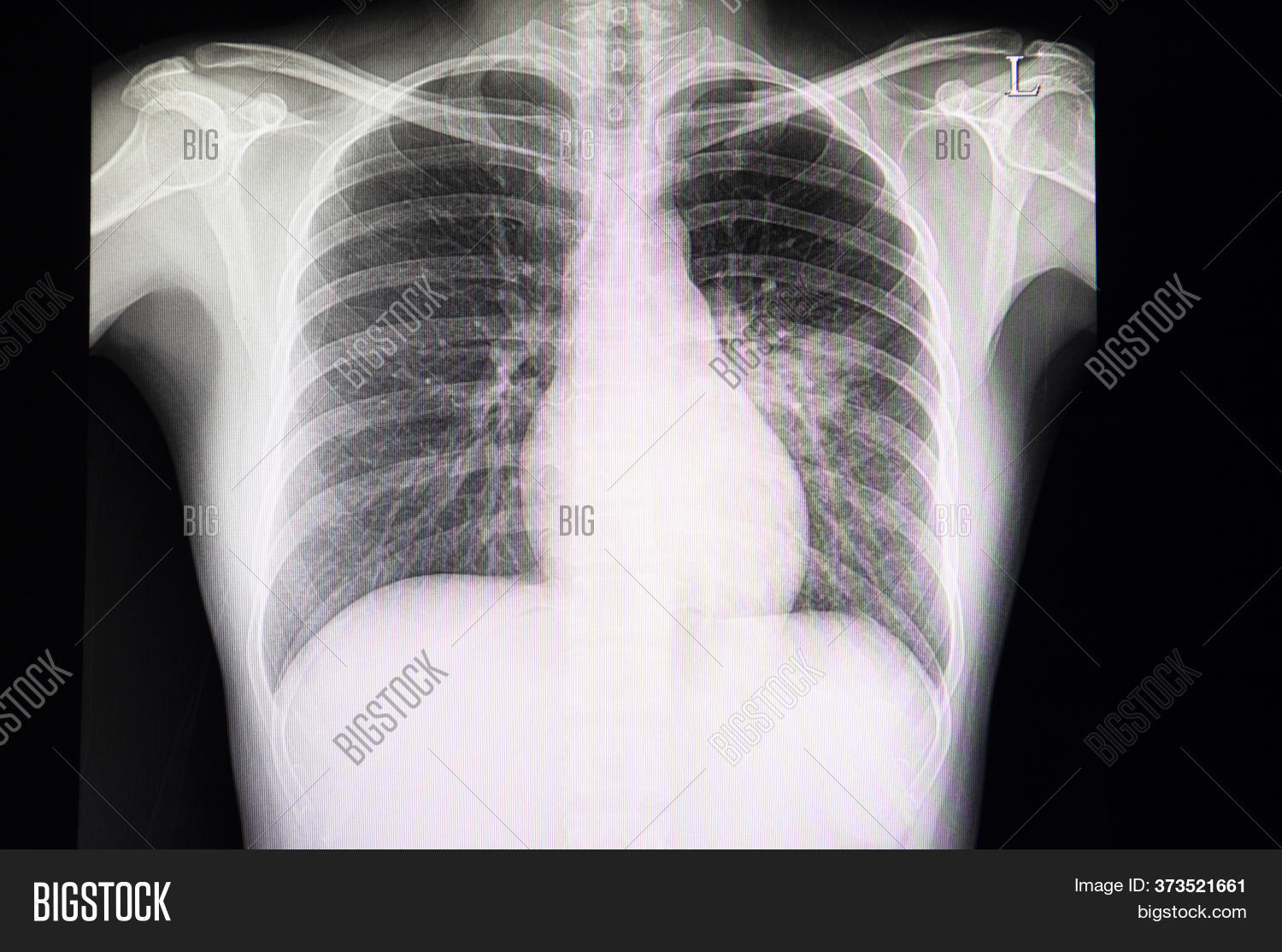 Chest X Ray Infiltrates