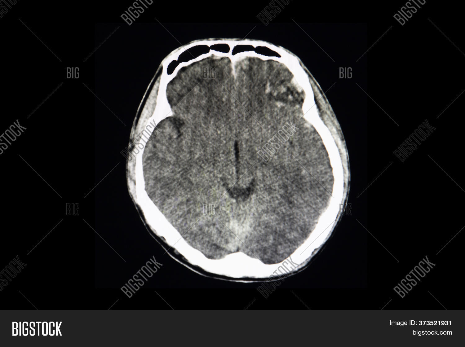 Ct Brain Scan Image & Photo (Free Trial) | Bigstock