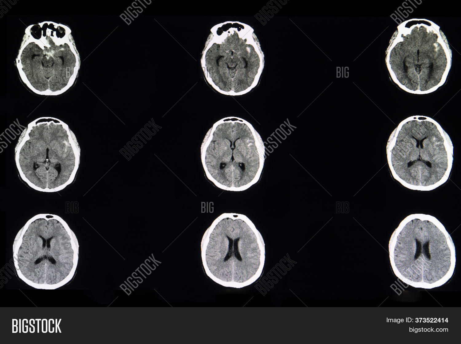 Ct Brain Scan Patient Image & Photo (Free Trial) | Bigstock