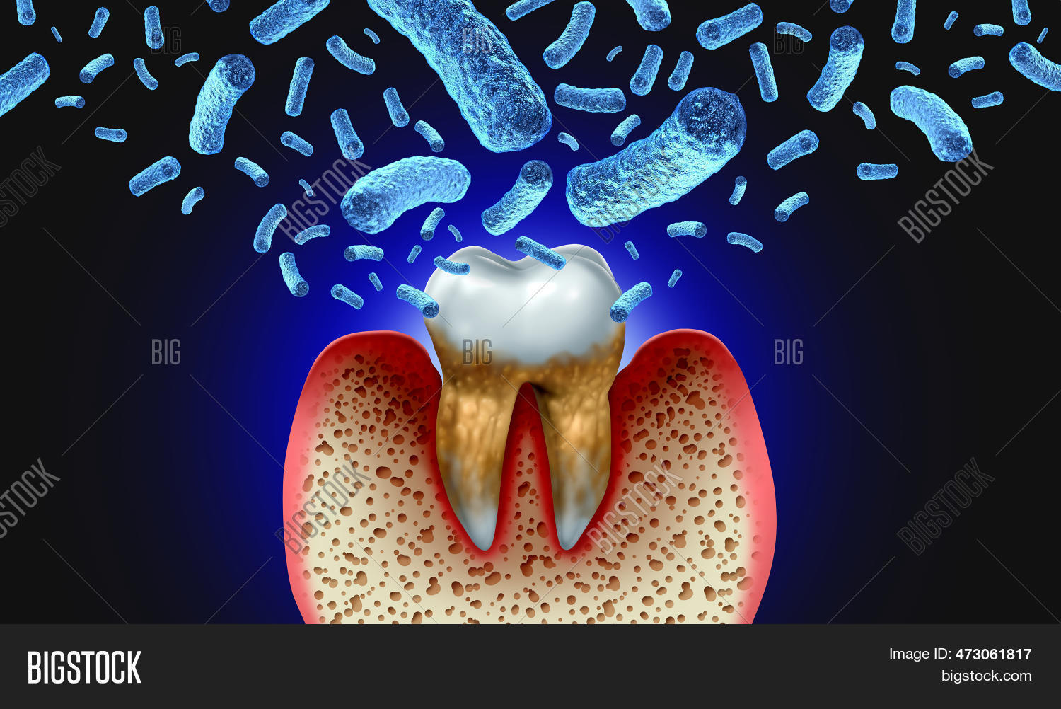Bacterial Tooth Image & Photo (Free Trial) | Bigstock