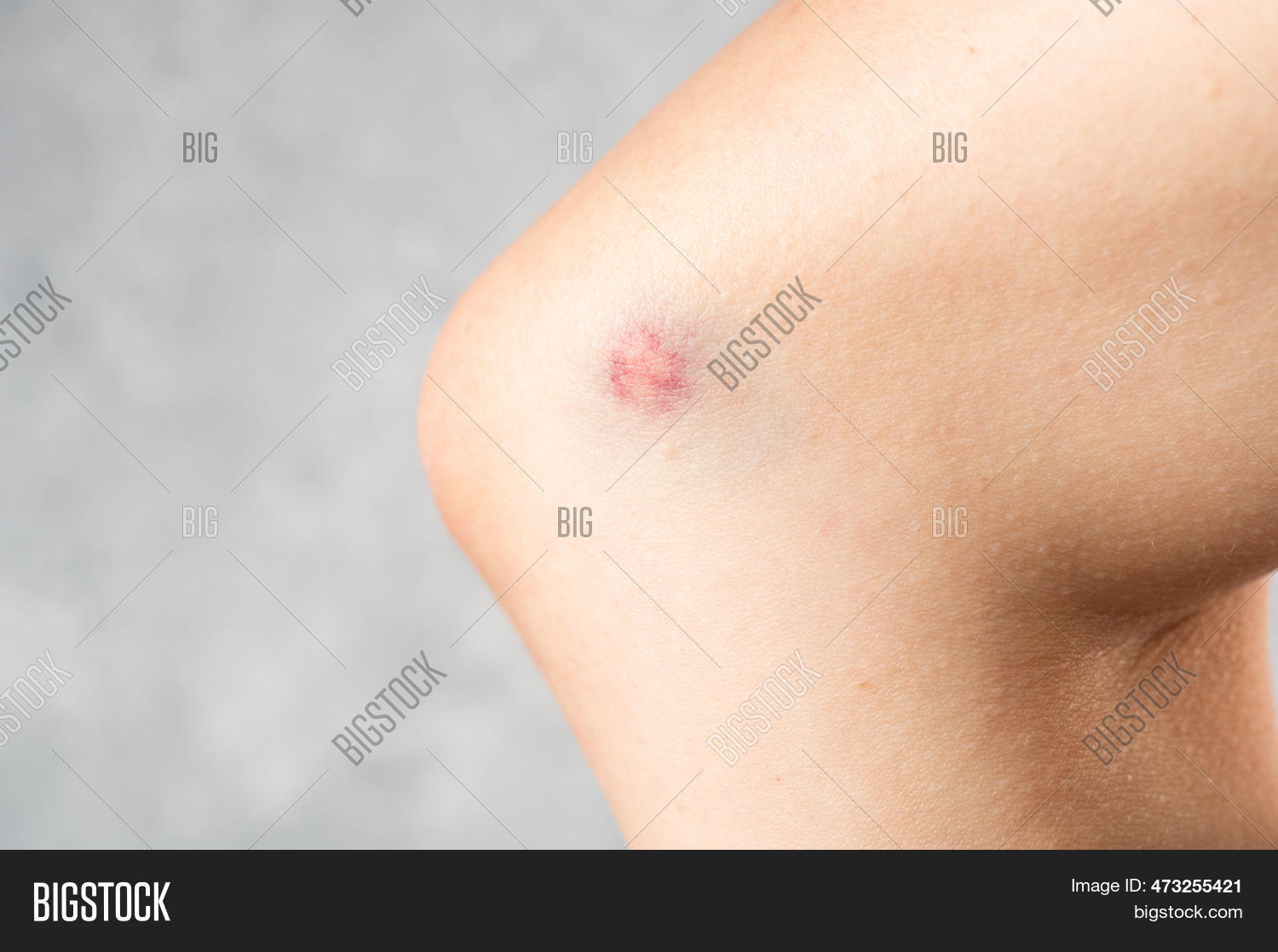 Big Bruise On Girls Image & Photo (Free Trial) | Bigstock