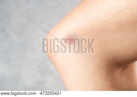 Big Bruise On Girls Image & Photo (Free Trial) | Bigstock