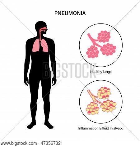 Pneumonia Infection Vector & Photo (Free Trial) | Bigstock