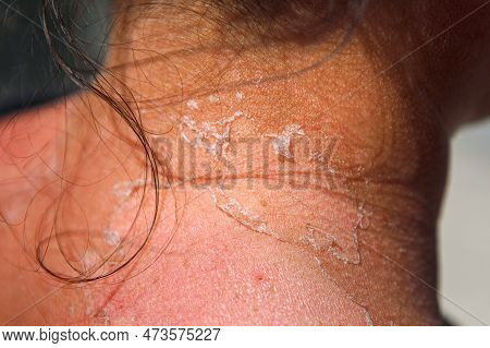 Neck Peeling Skin Image & Photo (Free Trial) | Bigstock