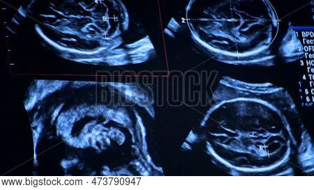 Utrasound Image On The Monitor Close-up. Ultrasound Scan Display ...