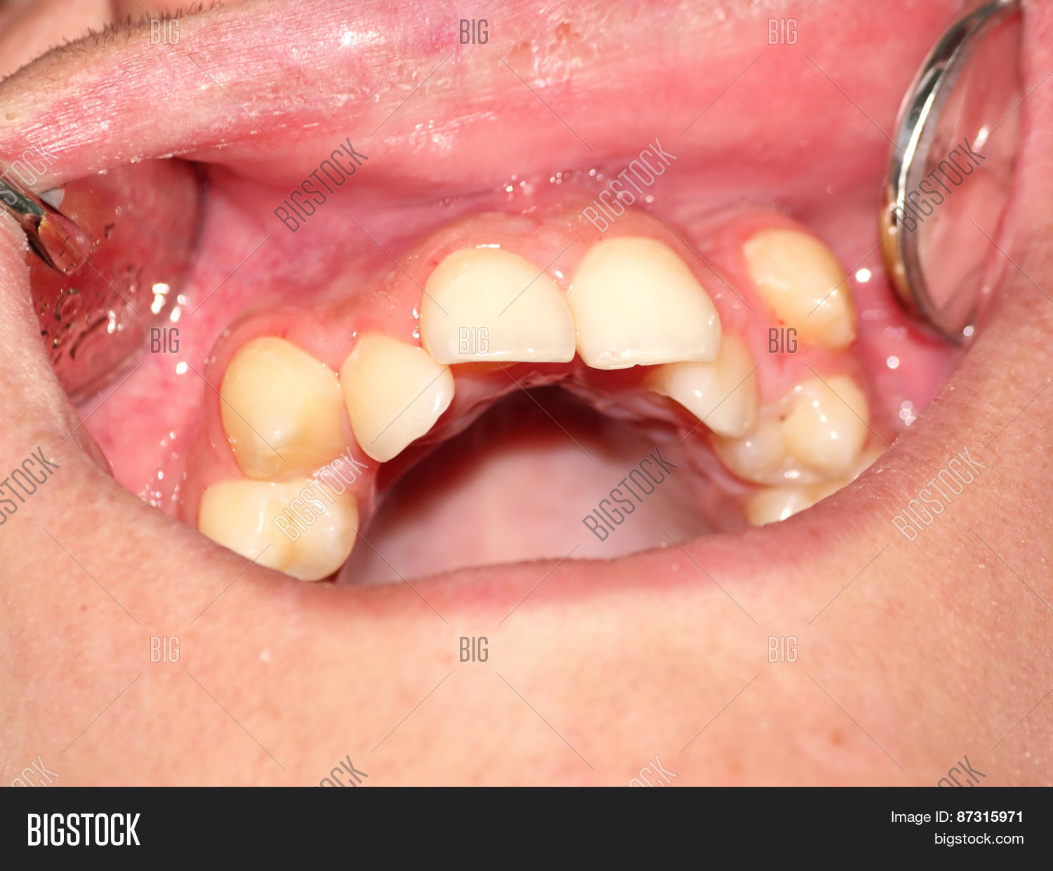 Crowding Teeth Upper Image & Photo (Free Trial) | Bigstock