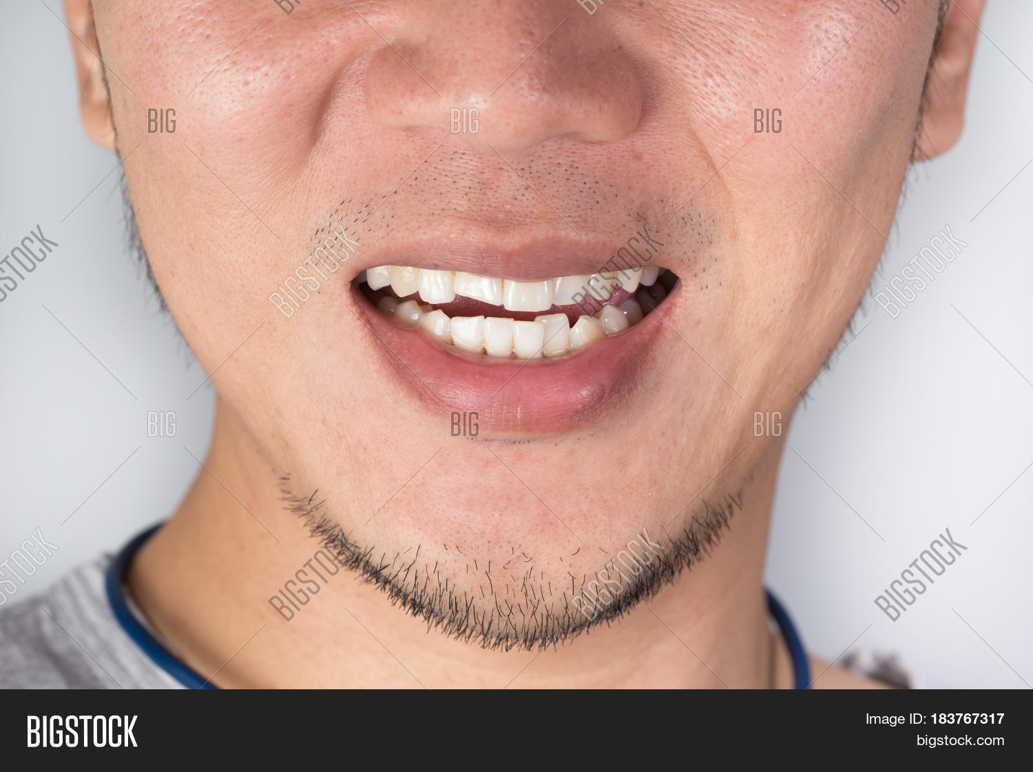 Ugly Smile Dental Image & Photo (Free Trial) | Bigstock