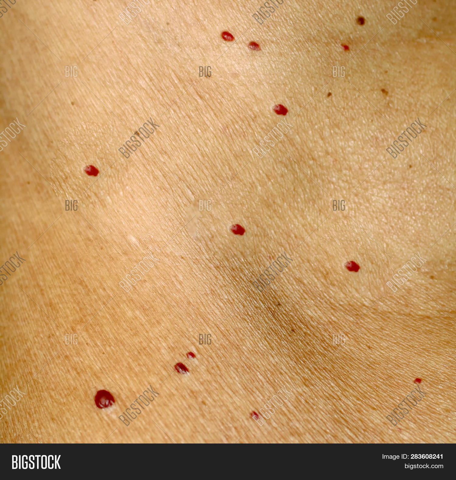 Angioma On Skin. Red Image & Photo (Free Trial) | Bigstock