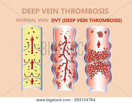 Thrombosis. Normal Image & Photo (Free Trial) | Bigstock