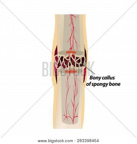3 Stage Healing Bone Vector & Photo (Free Trial) | Bigstock