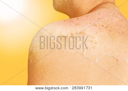 Sunny Sunburn Concept Image & Photo (Free Trial) | Bigstock