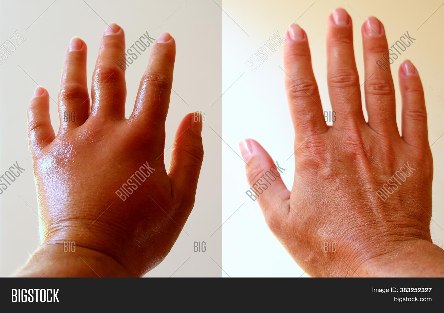 Left Arm Severely Image & Photo (Free Trial) | Bigstock