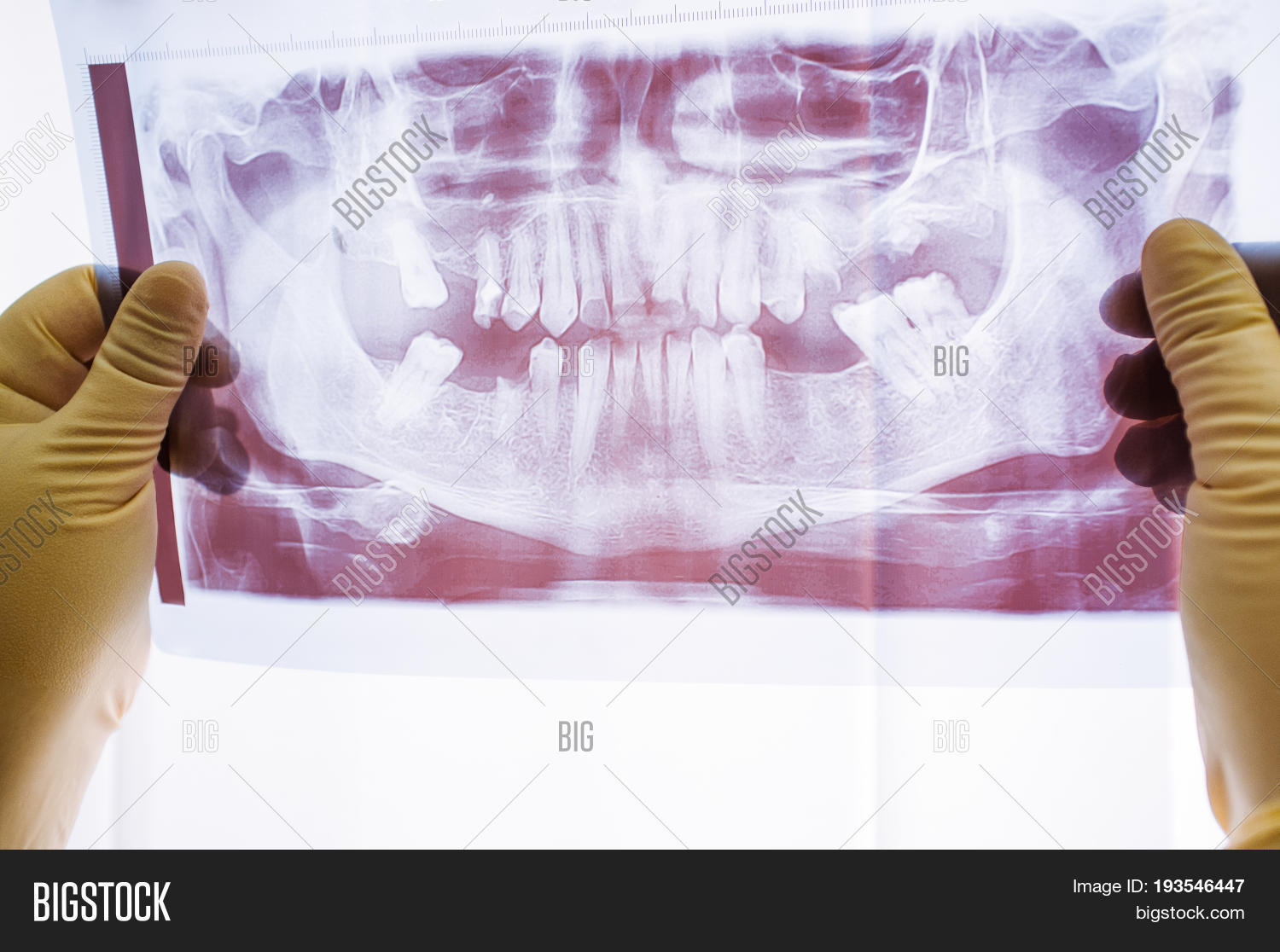 Dental X-ray Image & Photo (Free Trial) | Bigstock