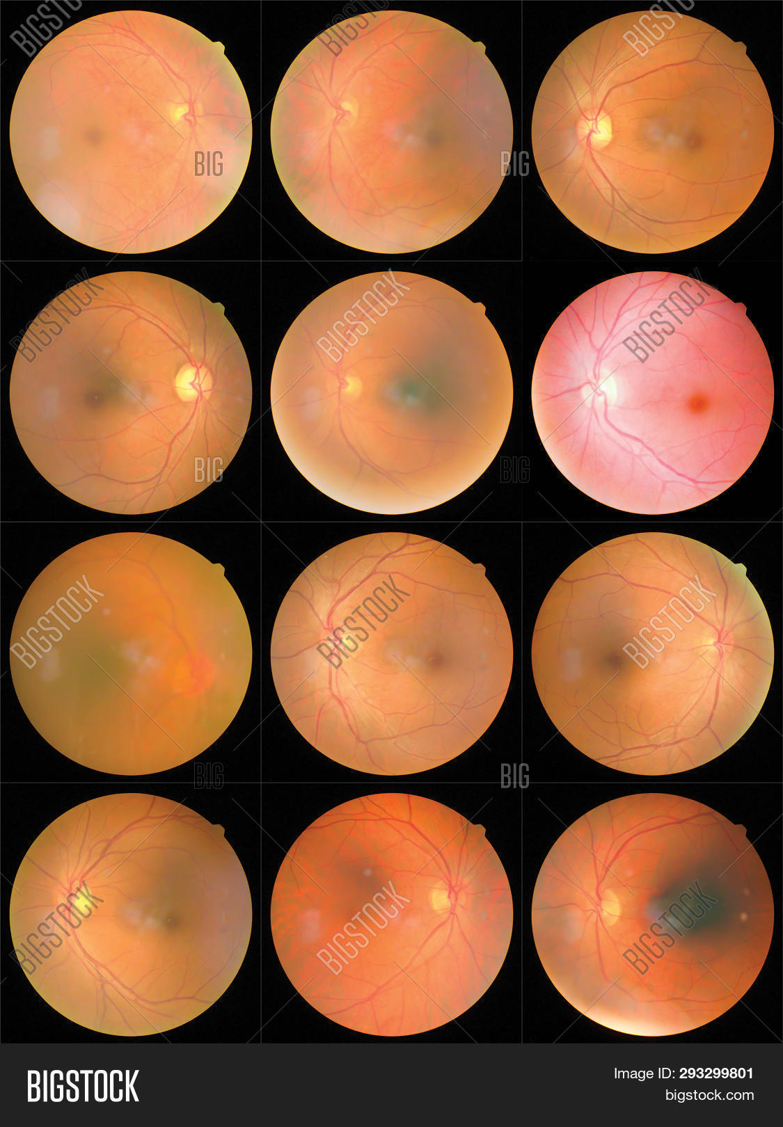 Collection Retinal Image & Photo (Free Trial) | Bigstock