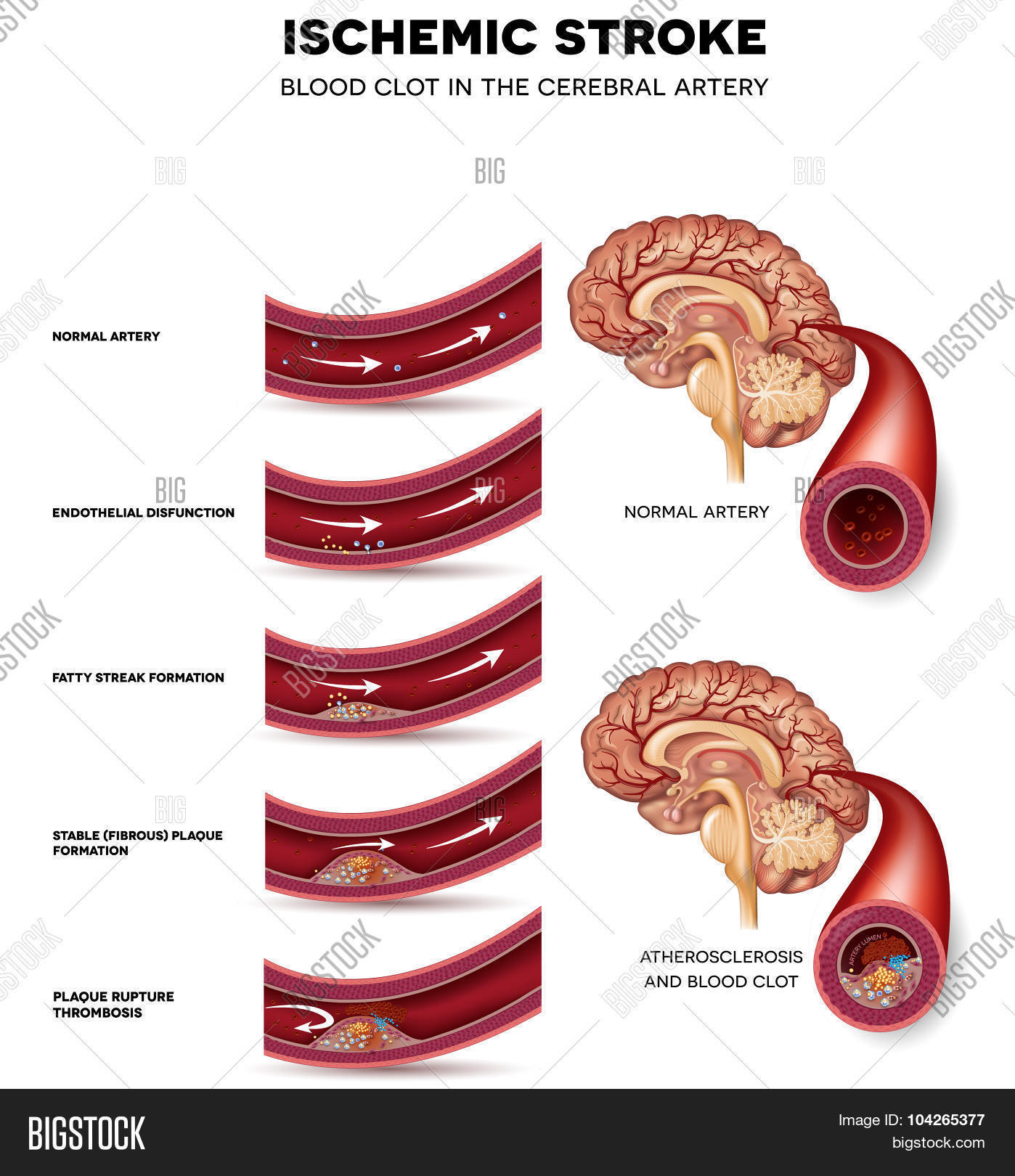 Blood Clot Formation Vector & Photo (Free Trial) | Bigstock
