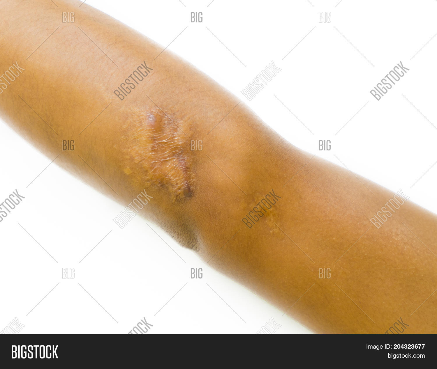Closeup Keloid Scar On Image & Photo (Free Trial) | Bigstock