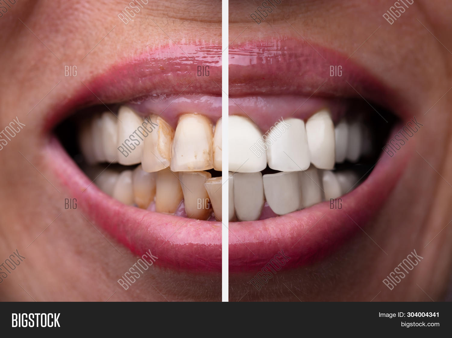 Female Teeth Between Image & Photo (Free Trial) | Bigstock