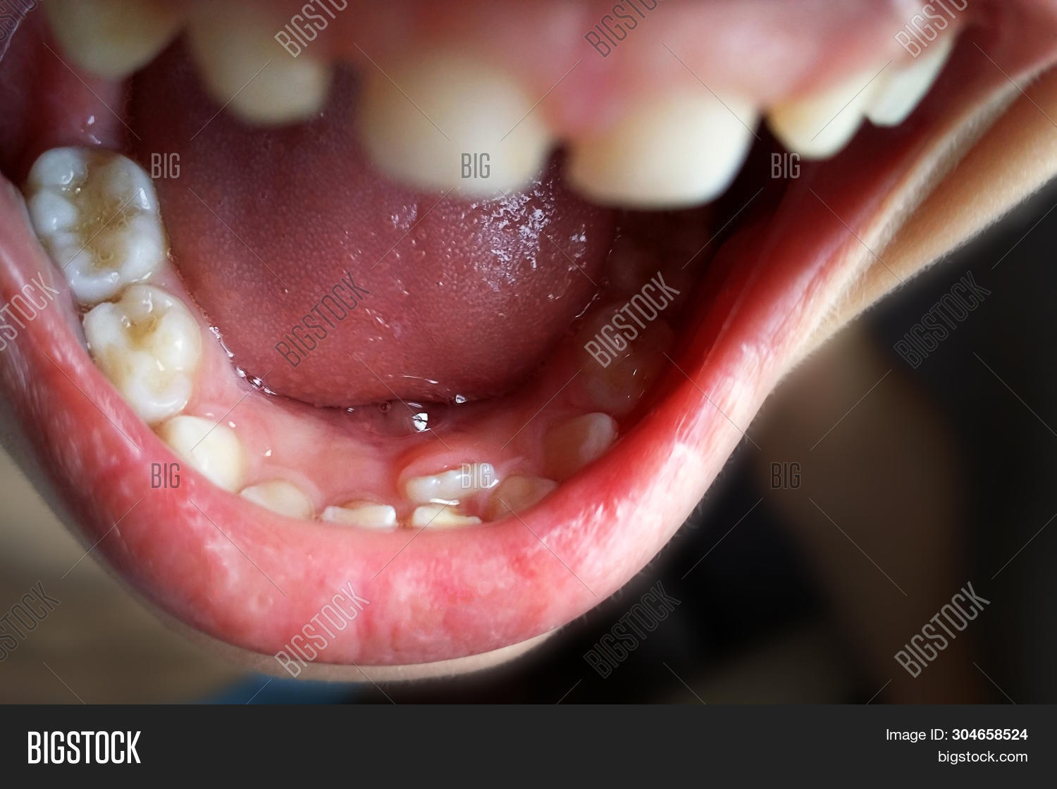 Permanent Tooth Adult Image & Photo (Free Trial) | Bigstock