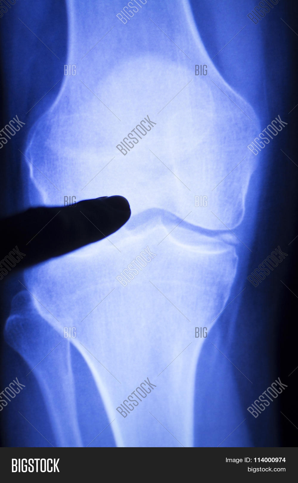 Knee Joint Meniscus X- Image & Photo (Free Trial) | Bigstock