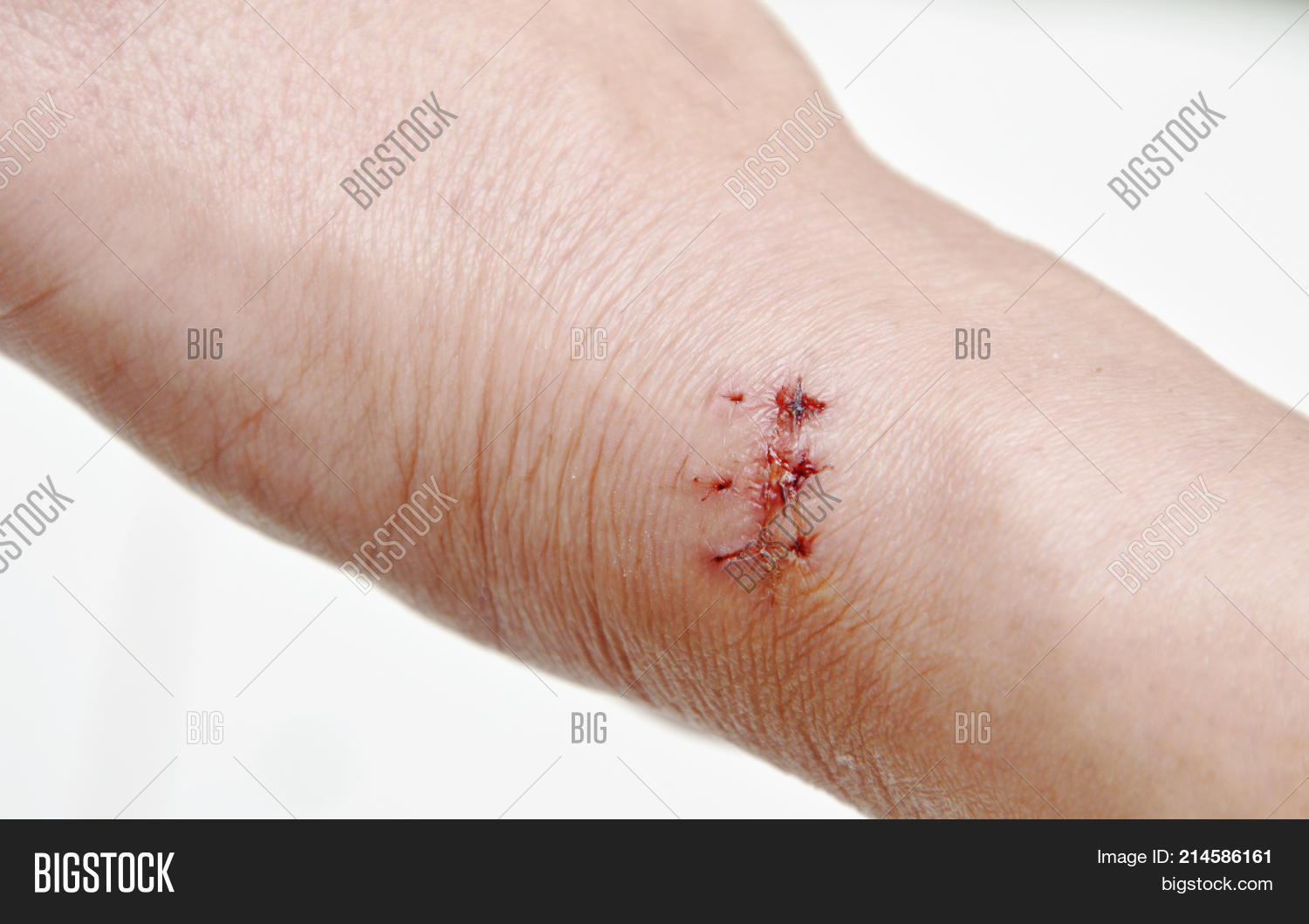 Stitched Wound Against White Background