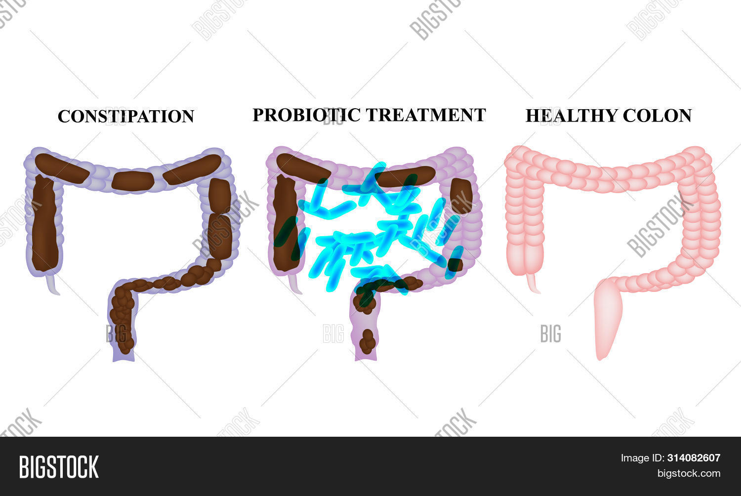Treatment Constipation Image & Photo (Free Trial) | Bigstock