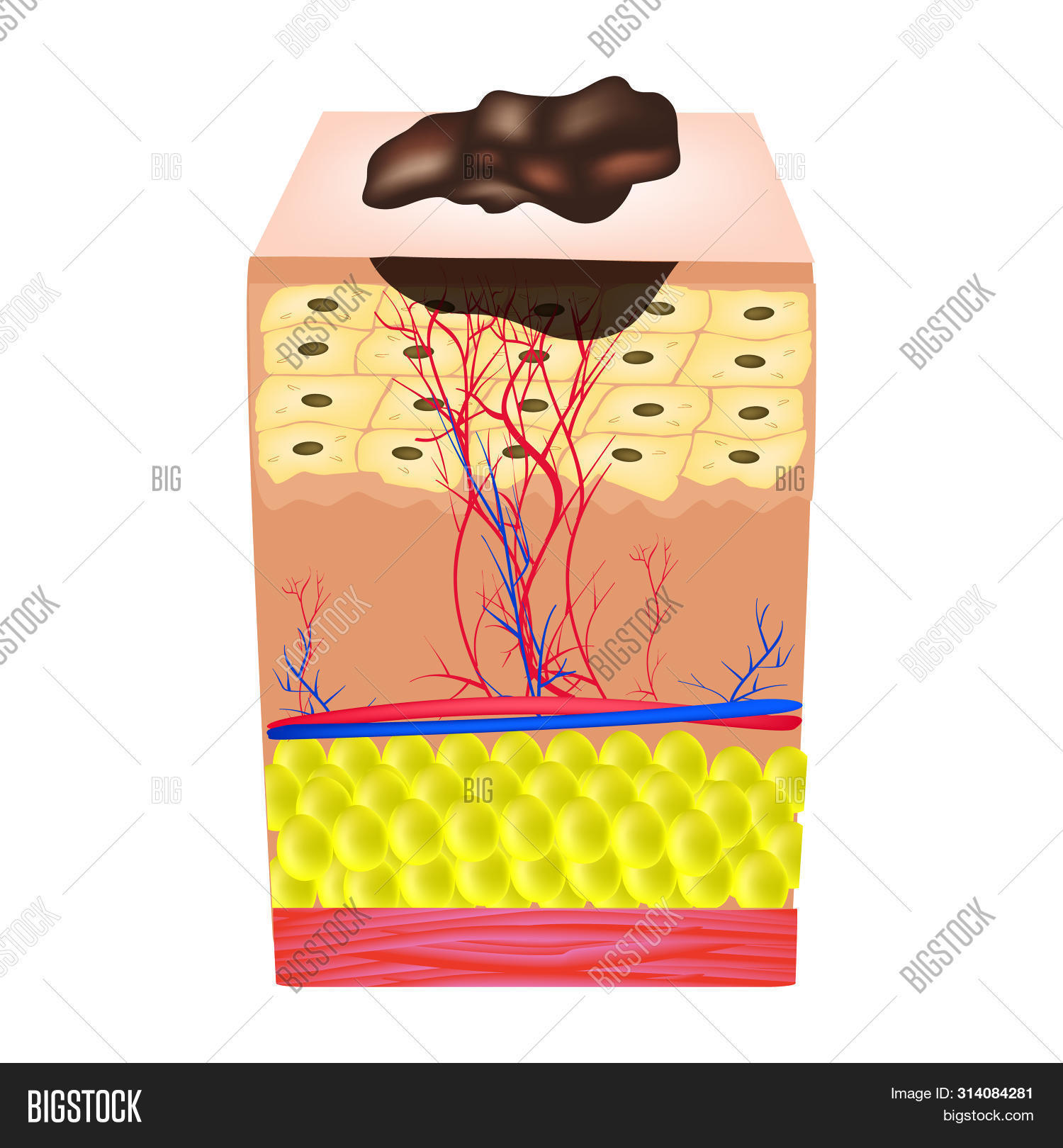 Structure Nevus. Image & Photo (Free Trial) | Bigstock