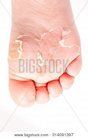After Red Rash Image & Photo (Free Trial) | Bigstock
