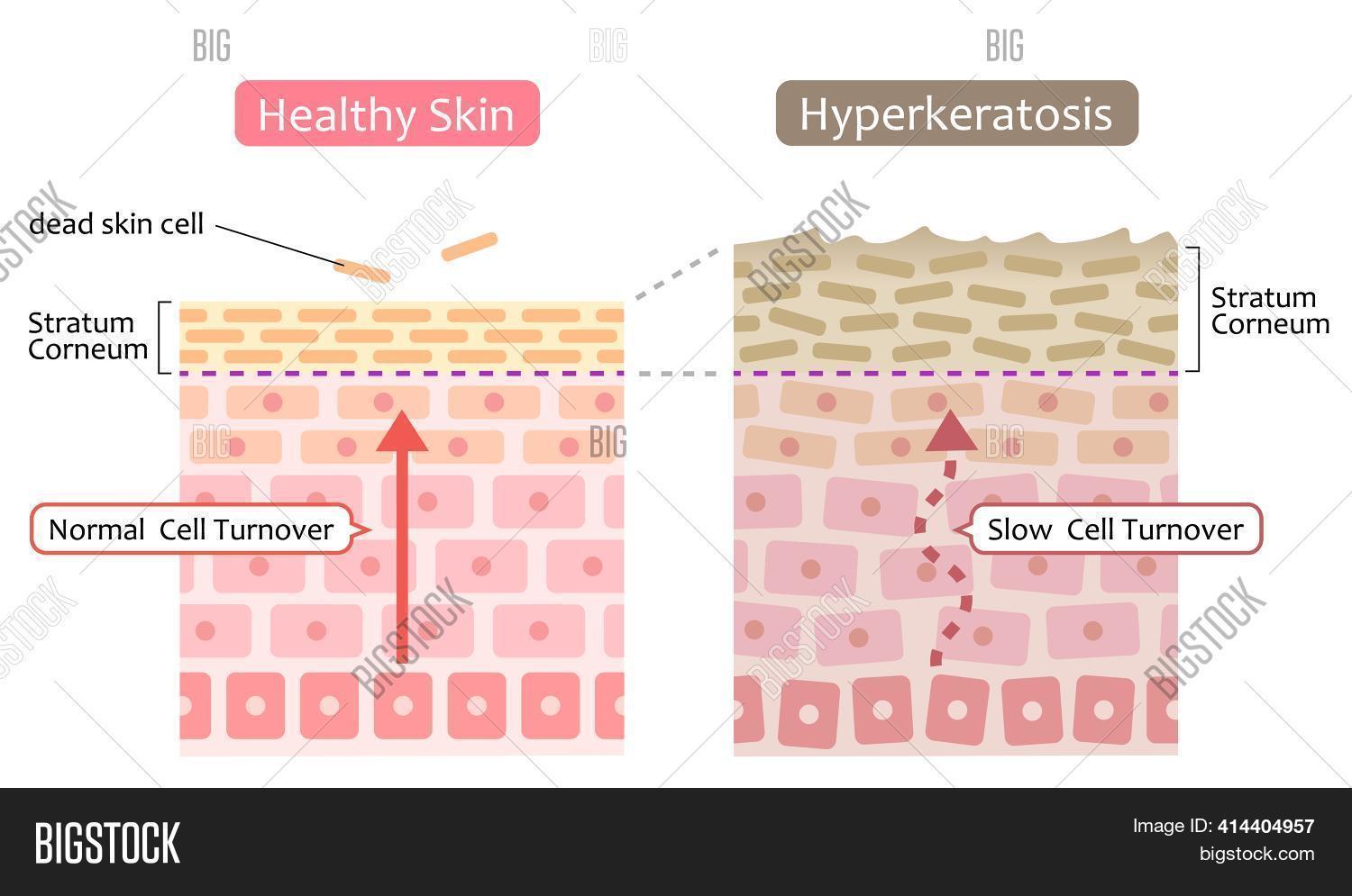 Diagram Skin Cell Image And Photo Free Trial Bigstock