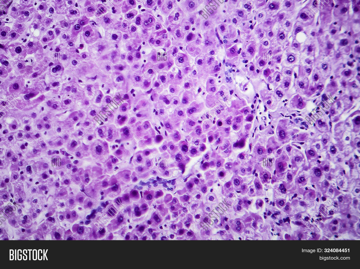 Cloudy Swelling Liver Image & Photo (Free Trial) | Bigstock