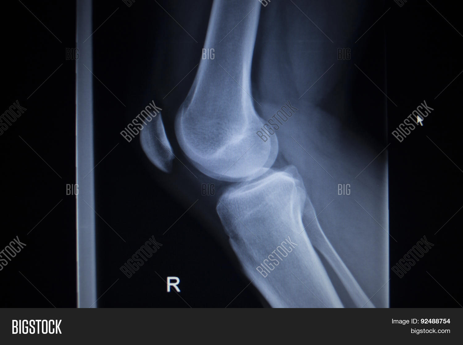X-ray Orthopedics Scan Image & Photo (Free Trial) | Bigstock