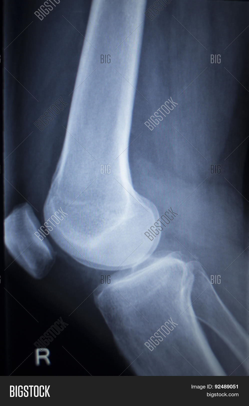 X-ray Orthopedics Scan Image & Photo (Free Trial) | Bigstock