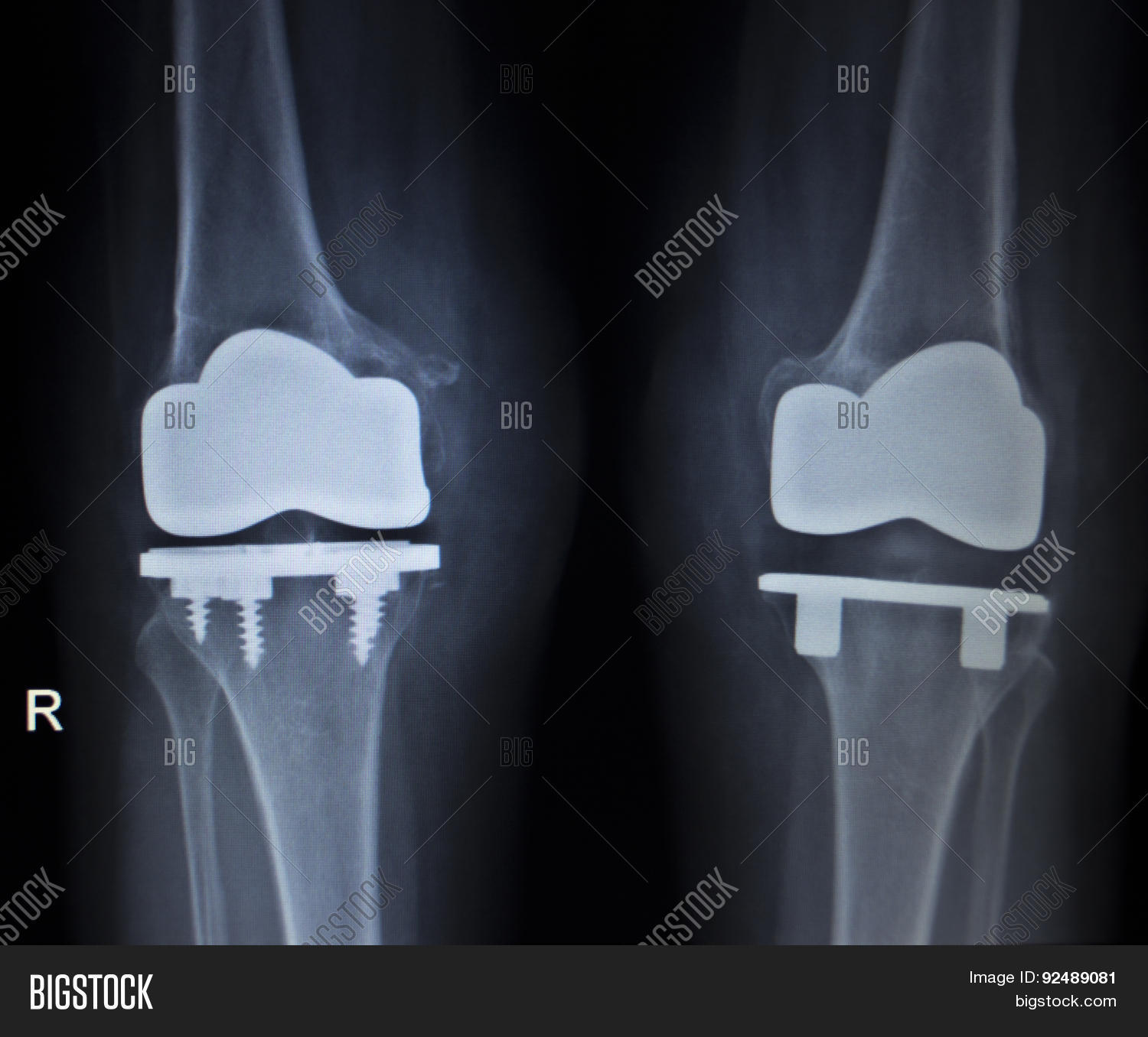 X-ray Orthopedics Scan Image & Photo (Free Trial) | Bigstock