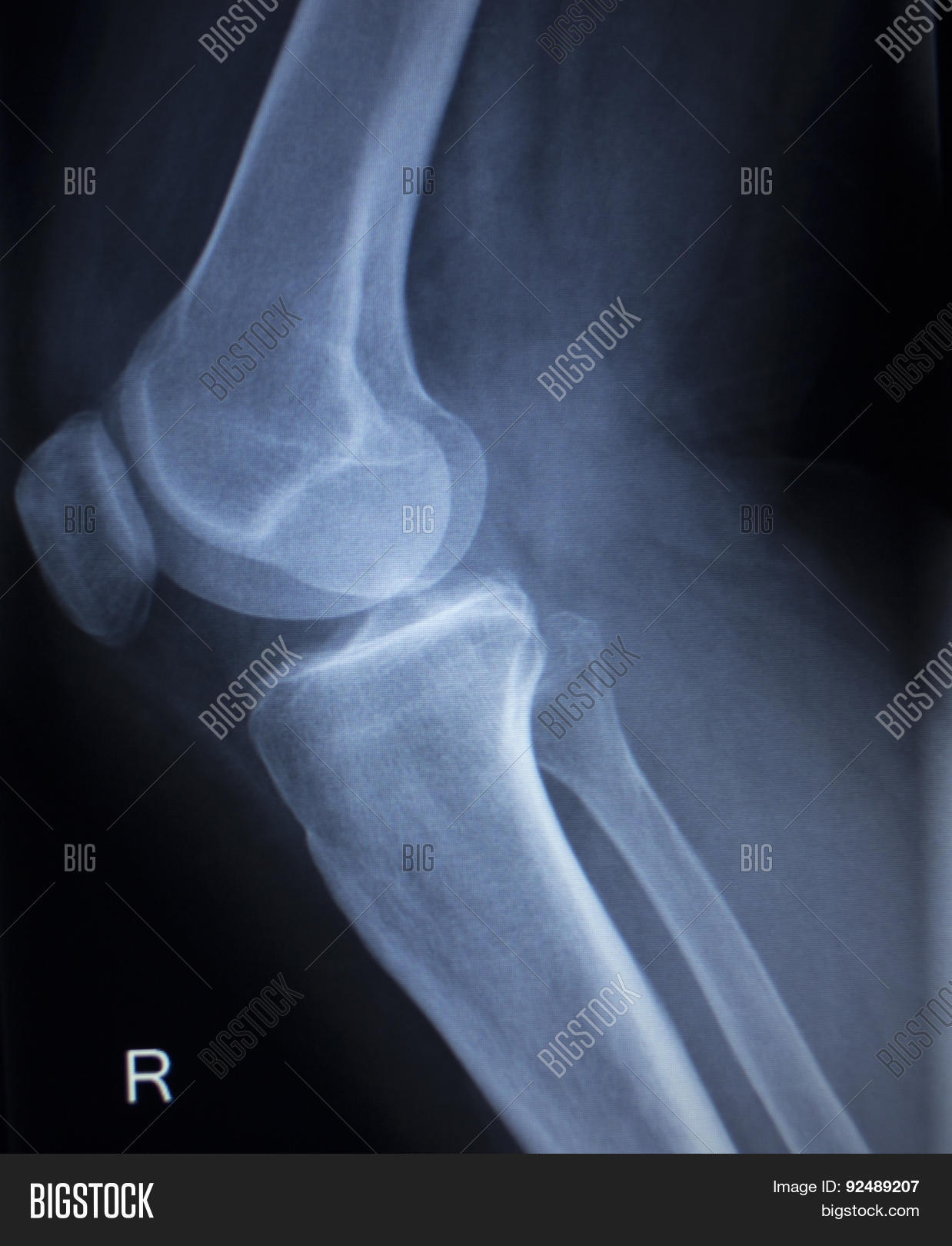 X-ray Orthopedics Scan Image & Photo (Free Trial) | Bigstock