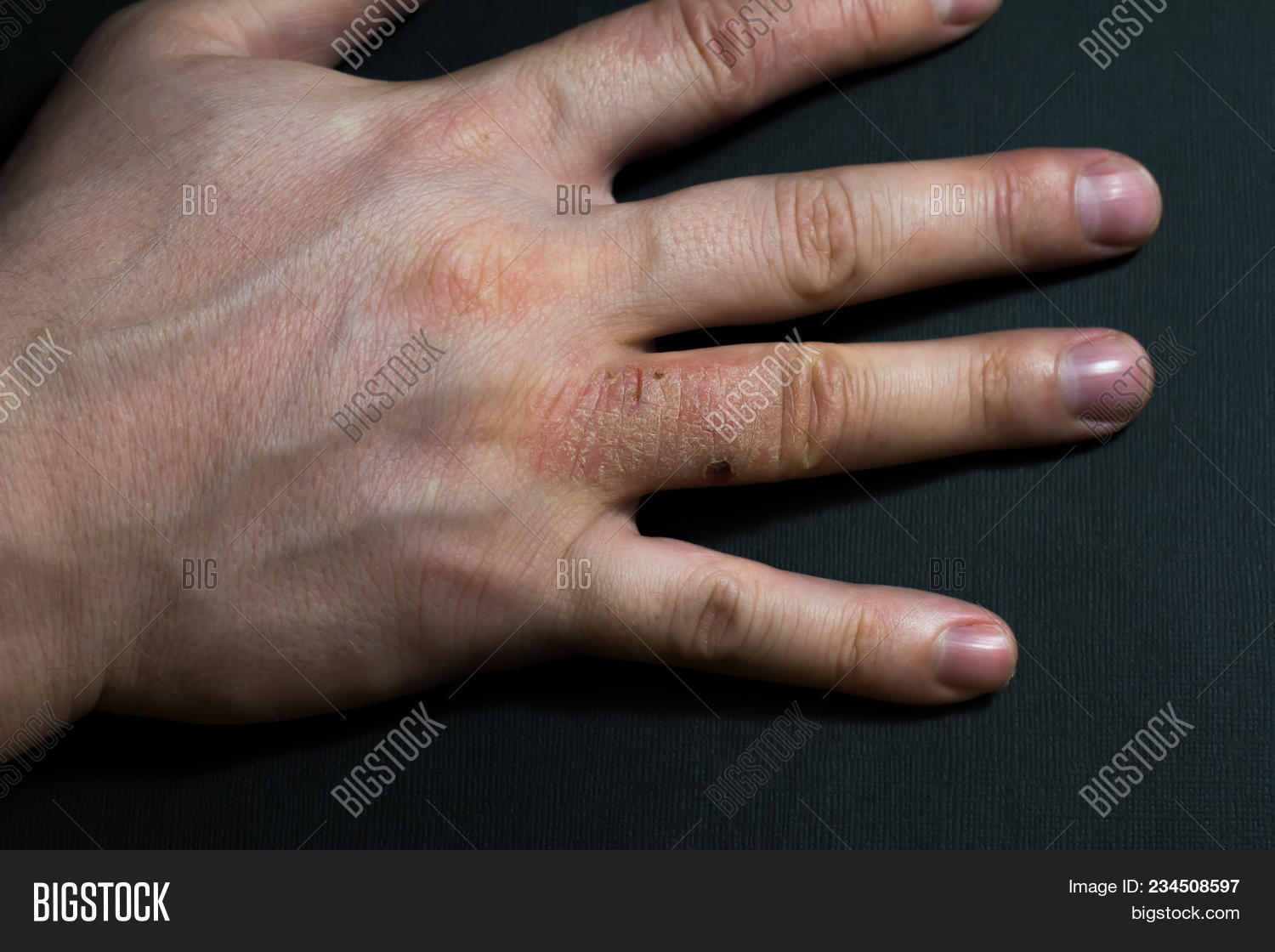 Hand Dermatitis. Hand Image & Photo (Free Trial) | Bigstock