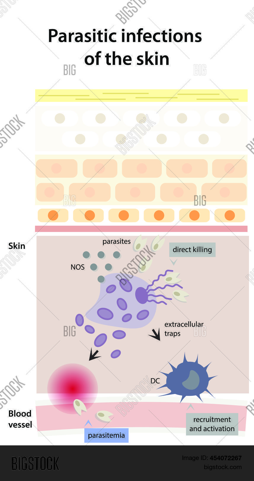 Parasitic Infections Vector & Photo (Free Trial) | Bigstock
