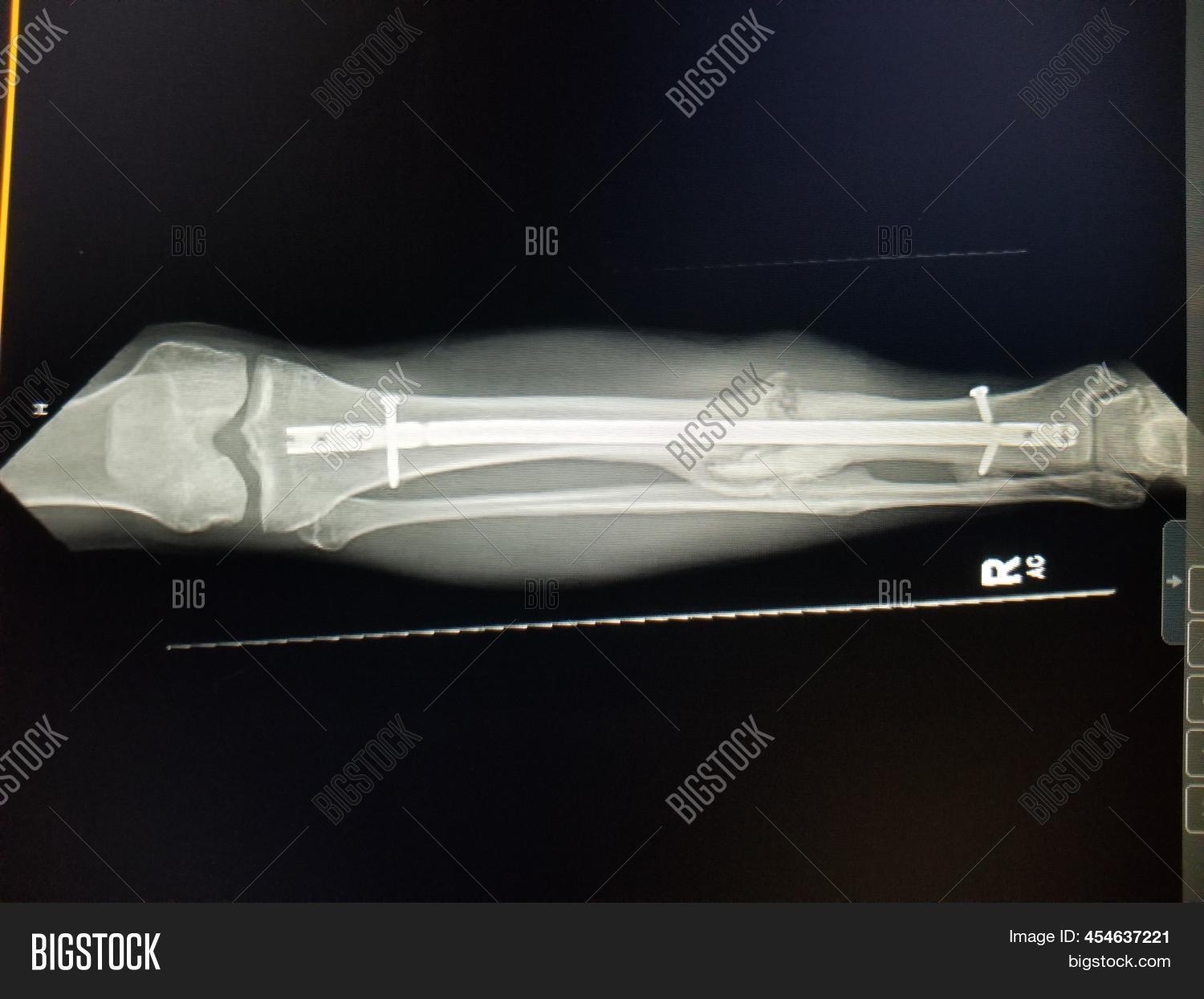 Right Tibial Fracture Image & Photo (Free Trial) | Bigstock