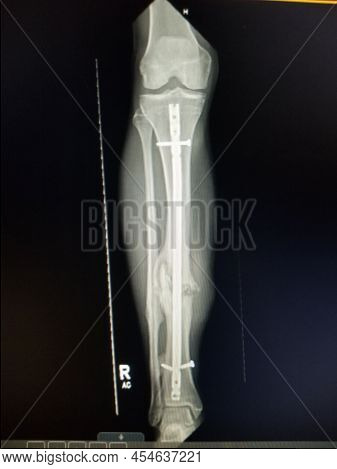 Right Tibial Fracture Image & Photo (Free Trial) | Bigstock