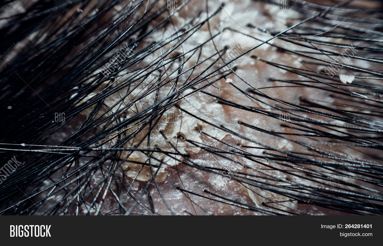 Hair Scalp Dandruff Image & Photo (Free Trial) | Bigstock